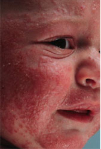 Eczema in Children – The Health Hub at Eaton Fair